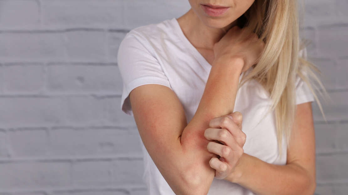 Nesselsucht (Urtikaria): Was hilft gegen die juckenden Quaddeln ...